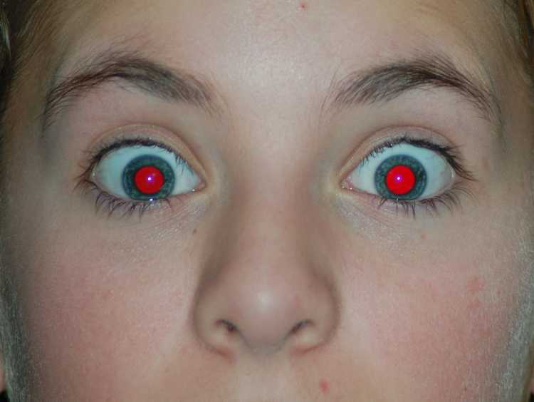 What Causes Bright Red Eyes In Photos? | Barrett Eubanks, M.D.